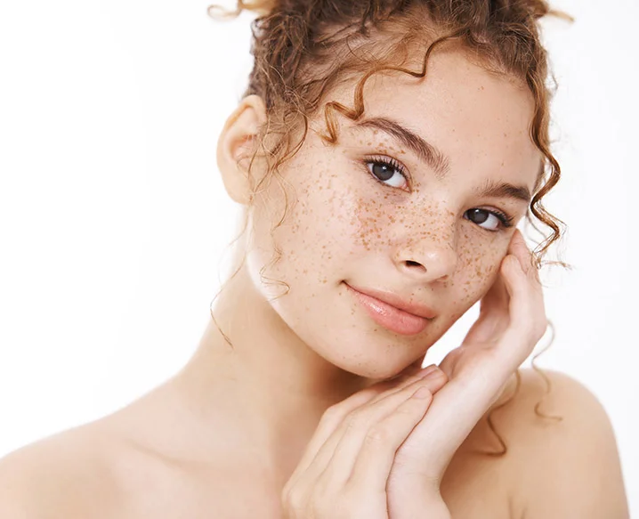 Freckles